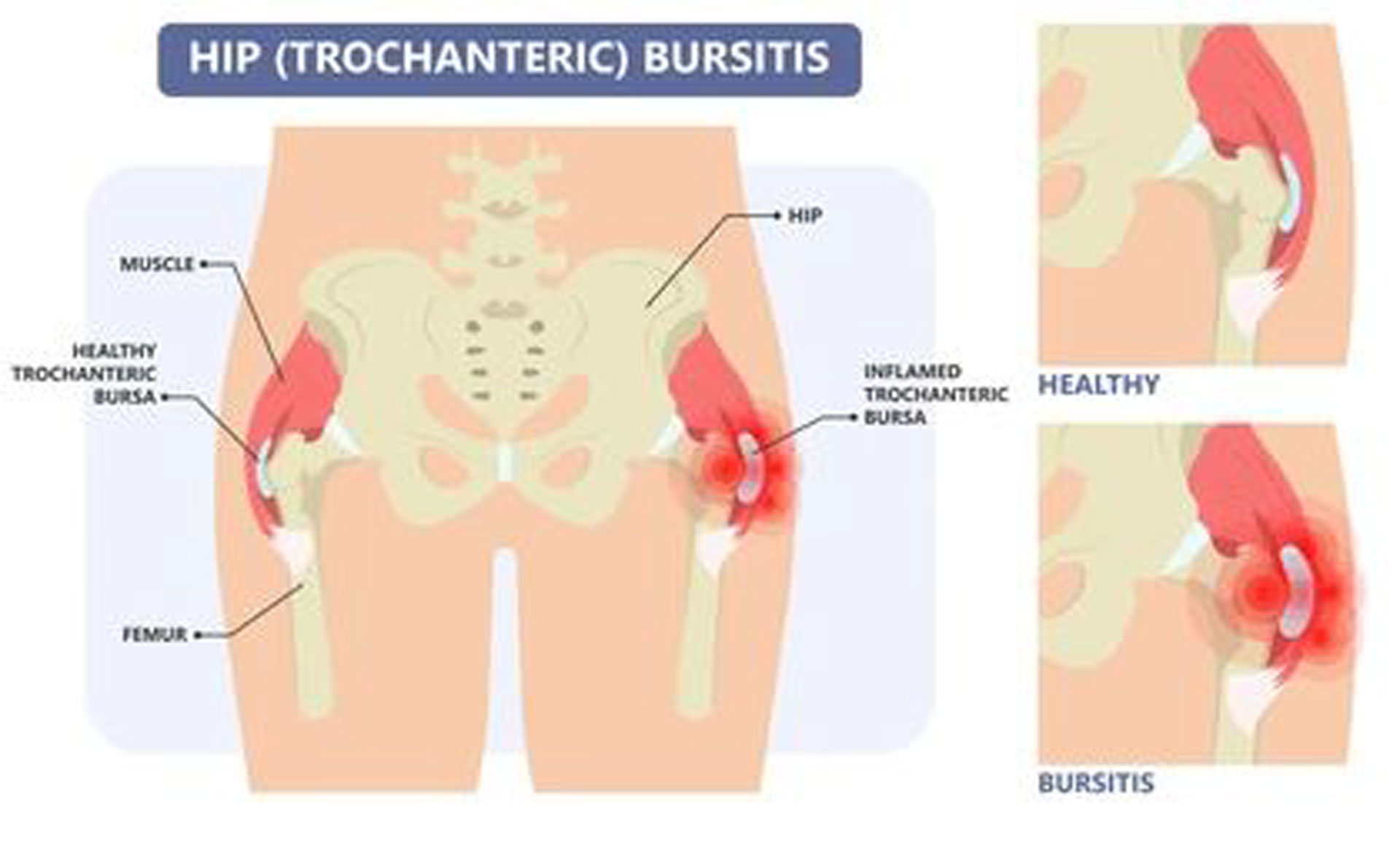 Hip Bursitis Treatment Causes And Symptoms Medical Wave